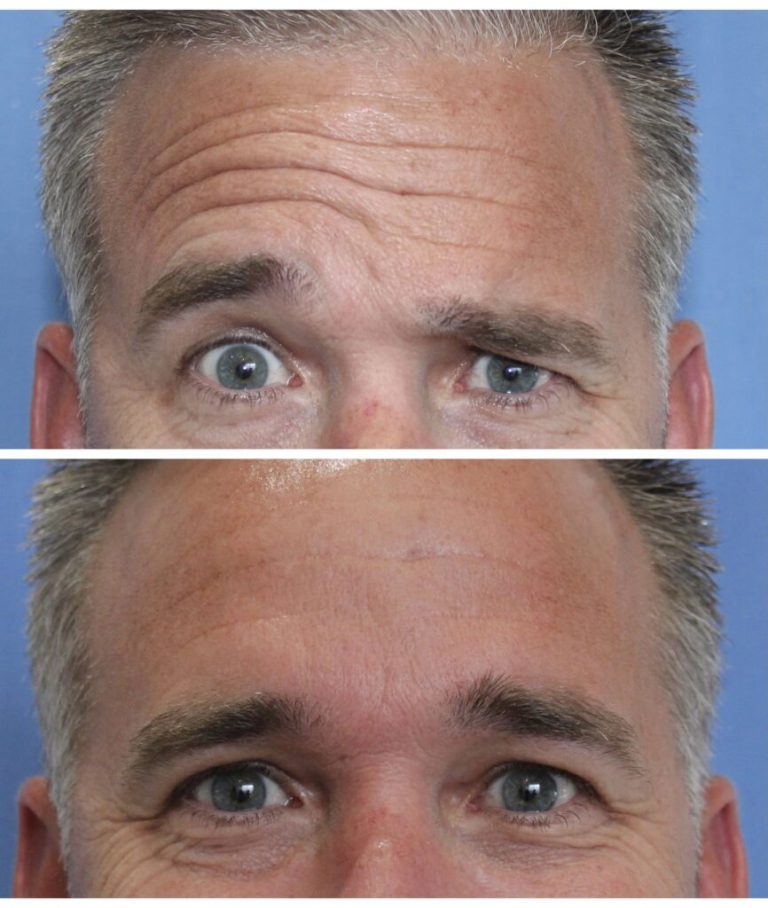Botox for Men Forehead: Benefits & Process Simplified