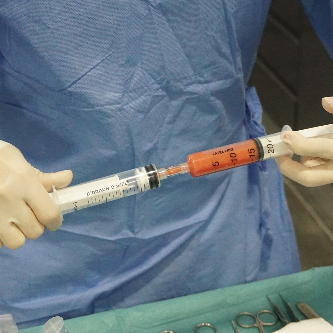 Discovering the Mental and Emotional Advantages of Fat Transfer